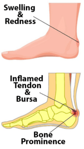 Battling Haglund's Deformity: A Journey Toward Relief - Foot, Ankle ...