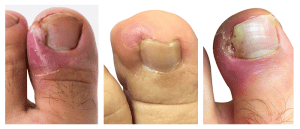 Ingrown Toenail Surgery - Foot & Ankle Experts